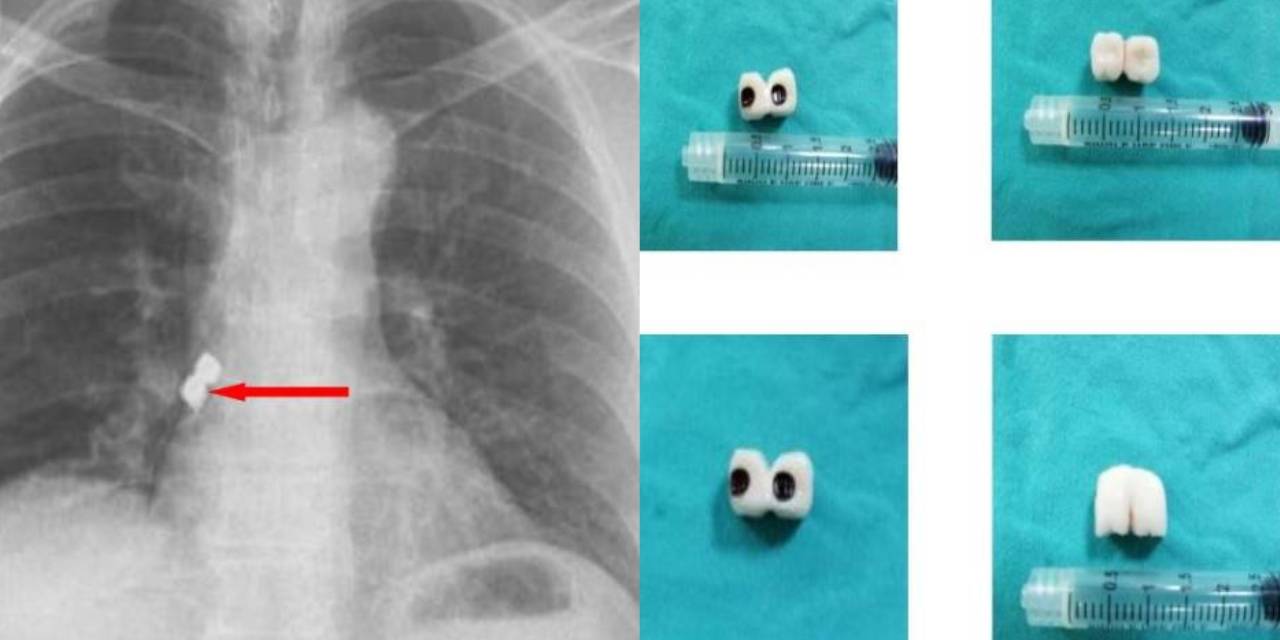 Diş Tedavisi Sırasında 2 İmplant Diş Soluk Borusuna Kaçtı
