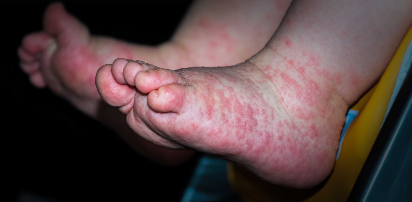 Çocuklardaki bu hastalık el ve ağızda yara yapıyor. Tedavisi ise sade ...